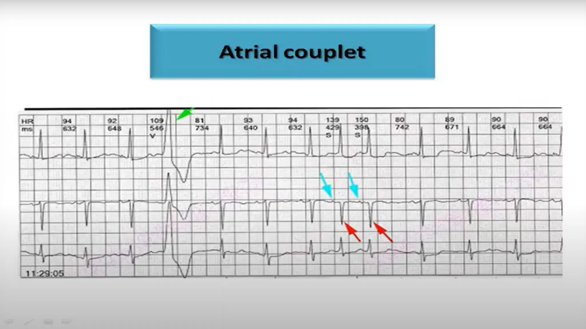 artrial and ventricular ectopic ecg teaching | PPTX
