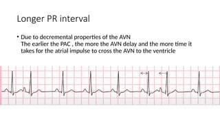 artrial and ventricular ectopic ecg teaching | PPTX