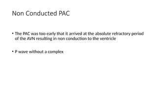 artrial and ventricular ectopic ecg teaching | PPTX