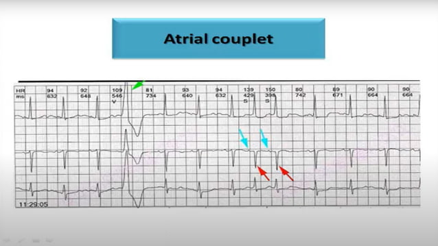 artrial and ventricular ectopic ecg teaching | PPTX