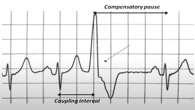 artrial and ventricular ectopic ecg teaching | PPTX