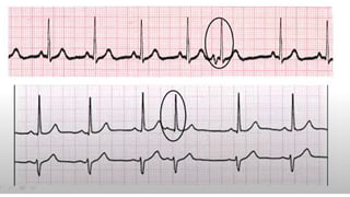 artrial and ventricular ectopic ecg teaching | PPTX