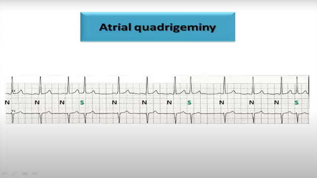 ventricular and atrial ectopic ecg teaching | PPTX