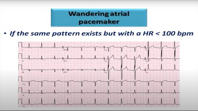 ventricular and atrial ectopic ecg teaching | PPTX