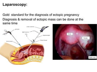 An ectopic pregnancy occurs when a fertilized egg implants and grows ...