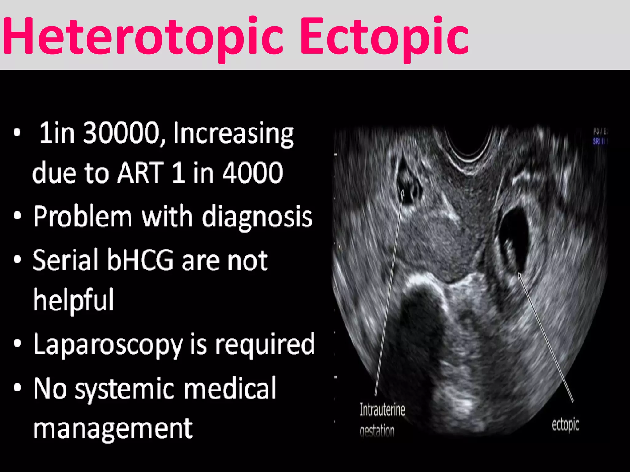 Ectopic Pregnancy | PPT