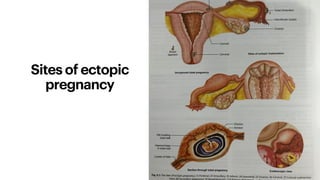 Ectopic-pregnancy, it's diagnosis, treatment and management | PDF