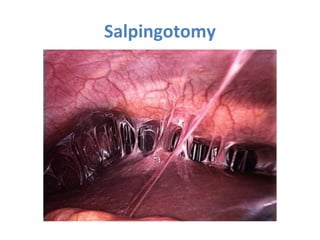 Ectopic Pregnancy | PPT