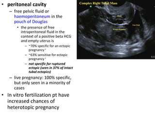 Ectopic gestation | PPT