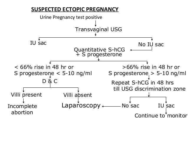 Ectopic Pregnancy