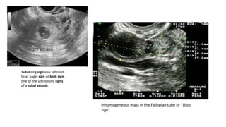 ECTOPIC PREGNANCY | PPTX