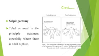 ECTOPIC PREGNANCY ppt | PPTX