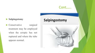 ECTOPIC PREGNANCY ppt | PPTX