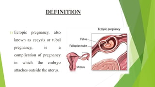 ECTOPIC PREGNANCY ppt | PPTX