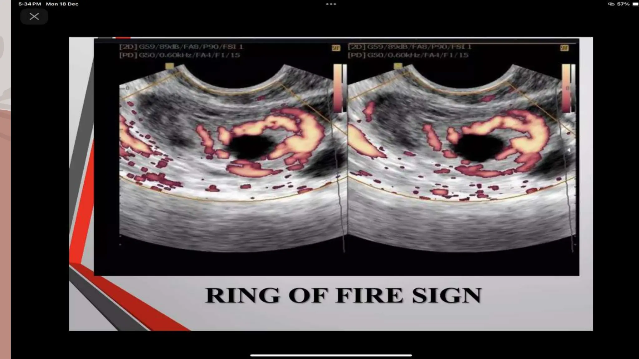 ectopic pregnancy types and radiology us findings | PPTX