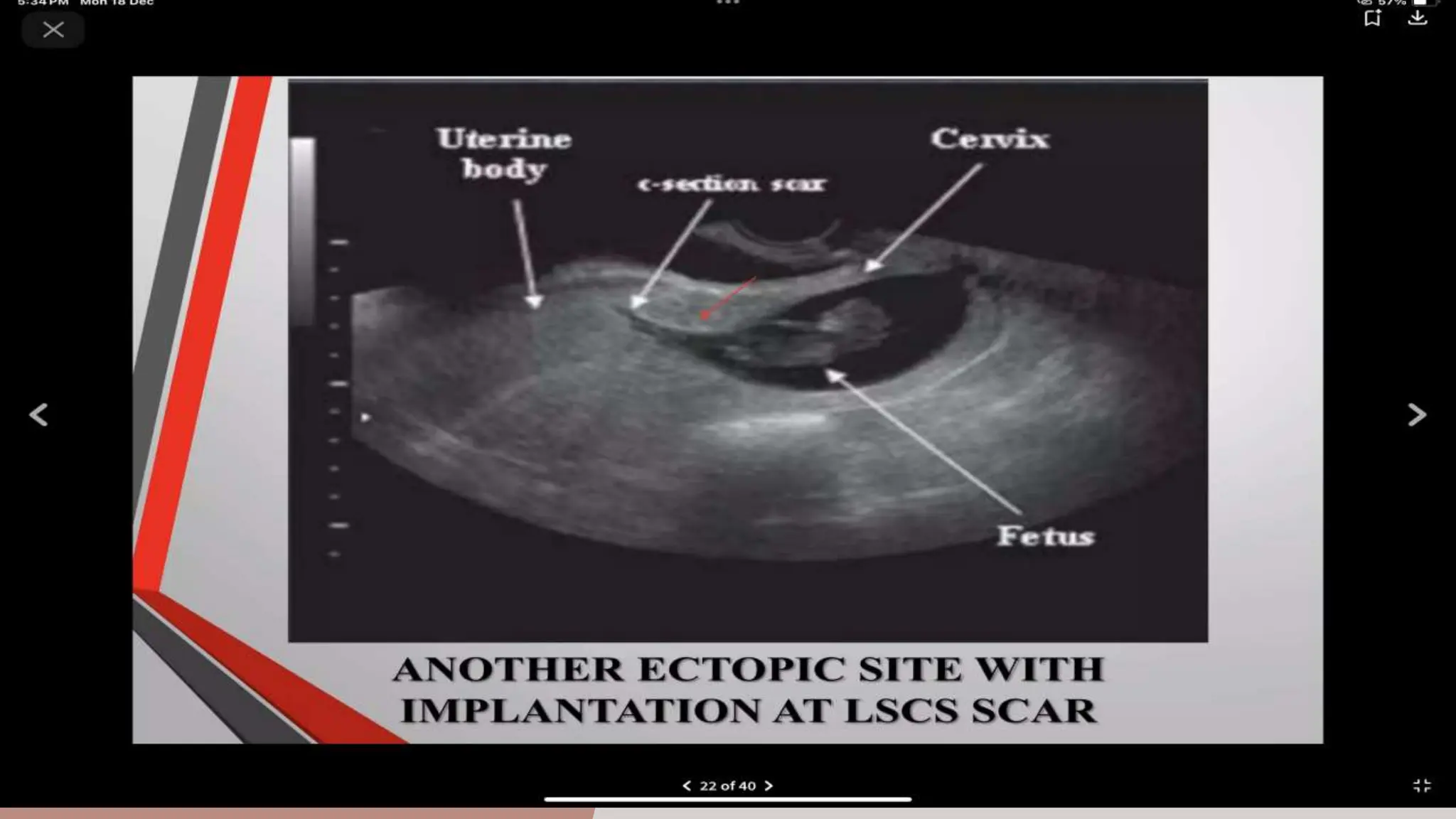 ectopic pregnancy types and radiology us findings | PPTX