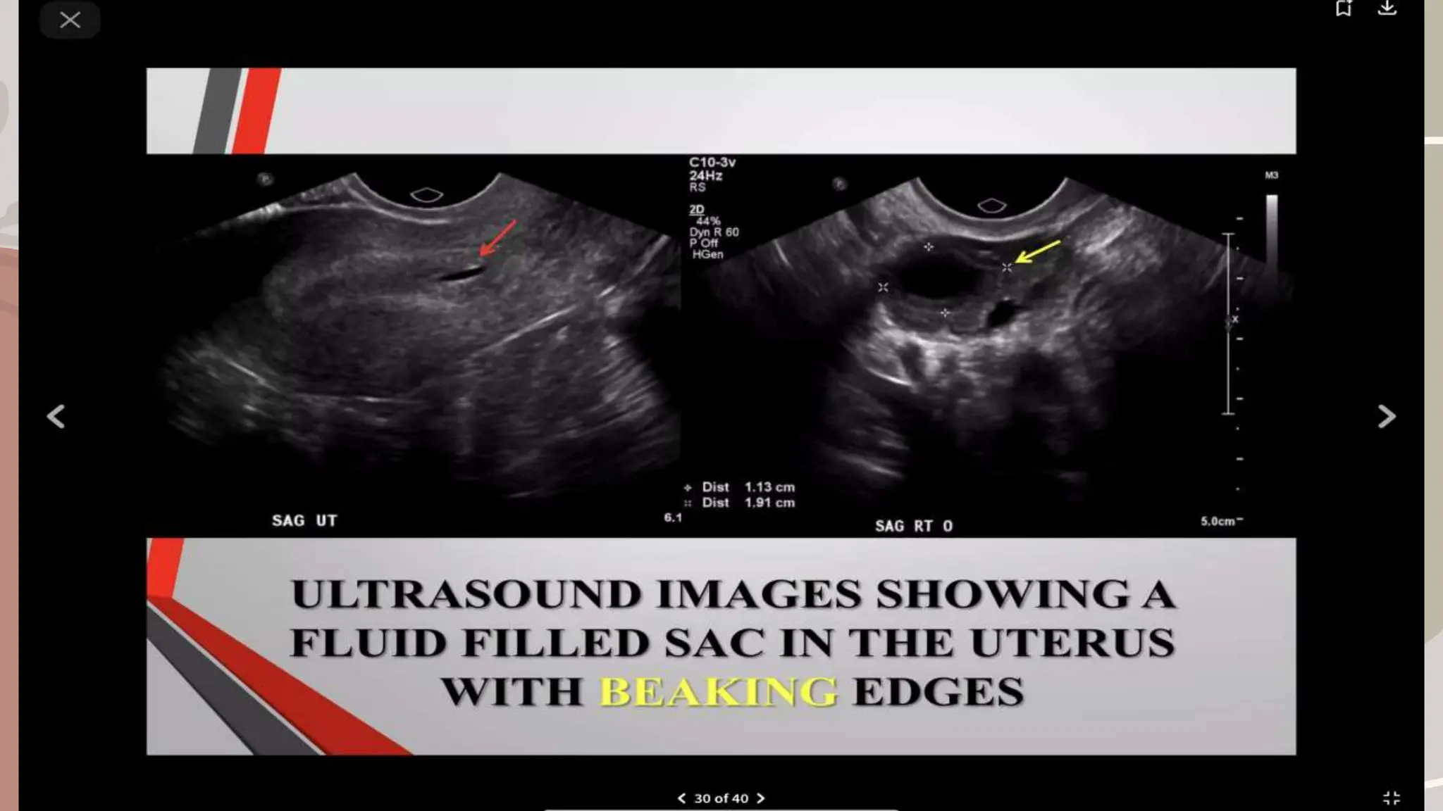 ectopic pregnancy types and radiology us findings | PPTX