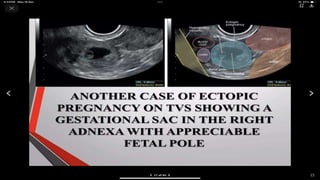 ectopic pregnancy types and radiology us findings | PPTX