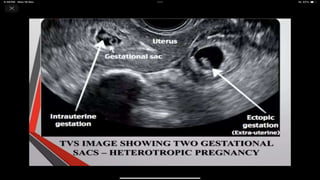 ectopic pregnancy types and radiology us findings | PPTX