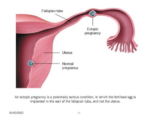 Ectopic Pregnancy from public h.....pptx