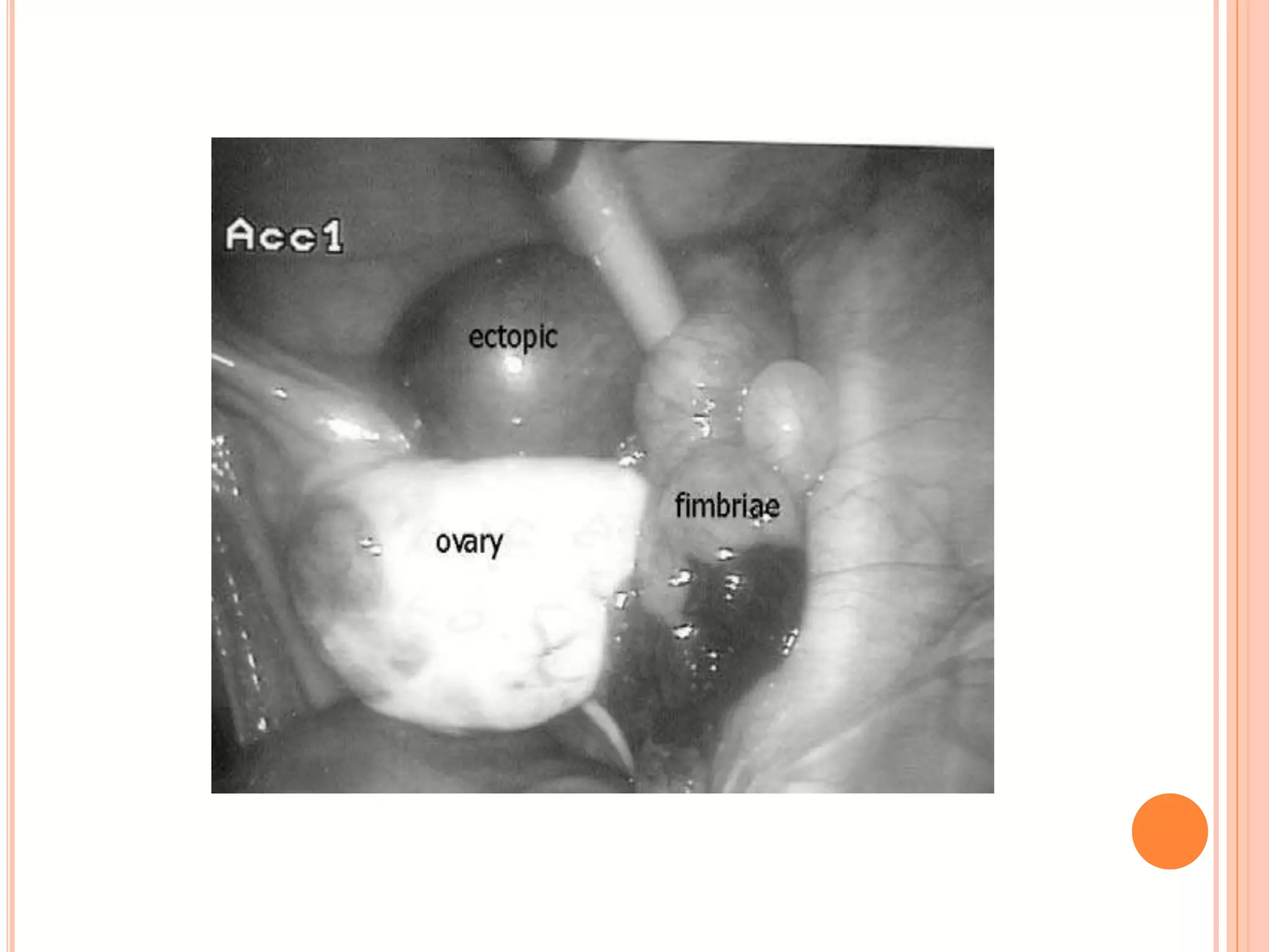 Ectopic pregnancy | PPTX