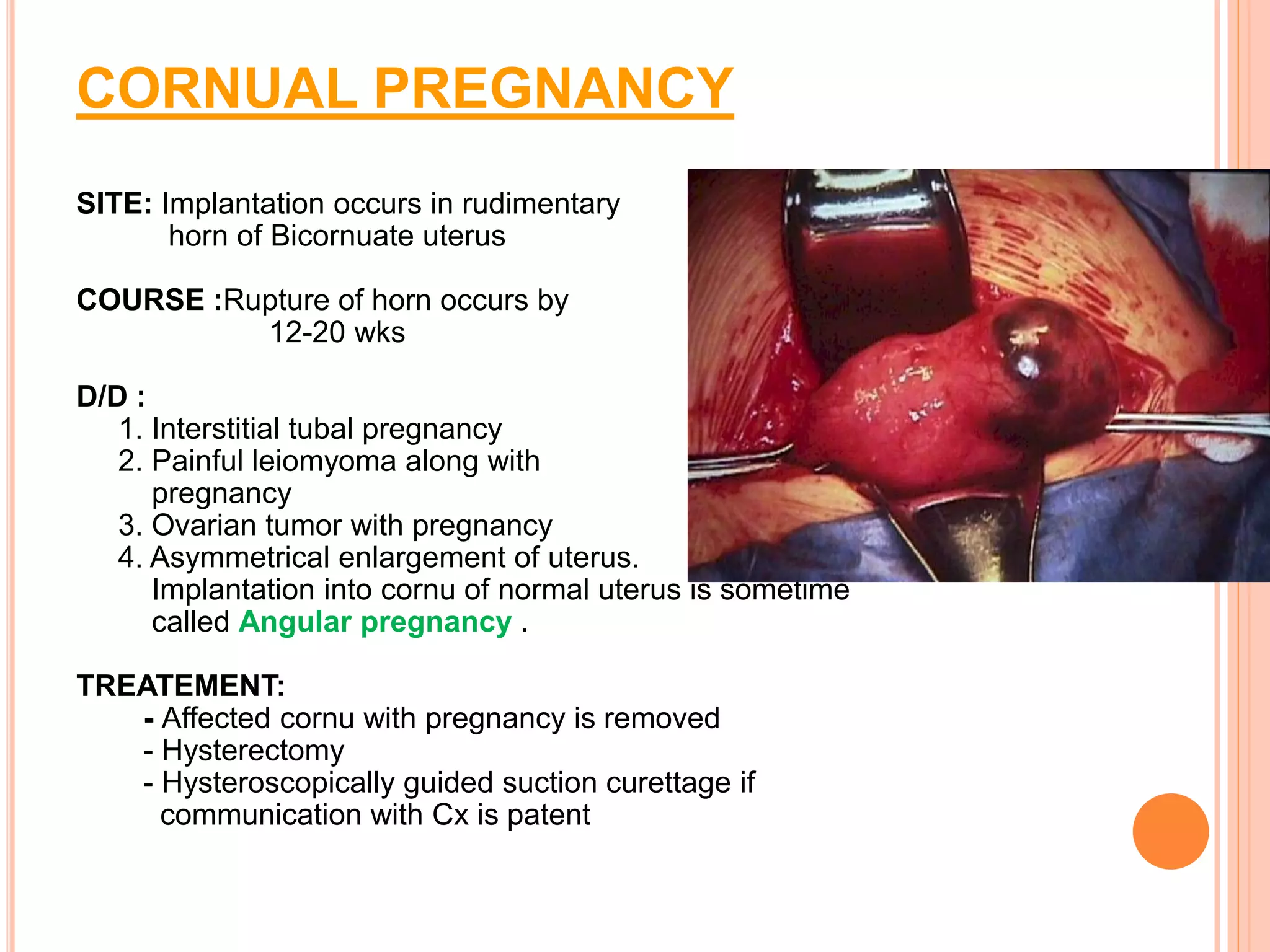 Ectopic pregnancy | PPTX