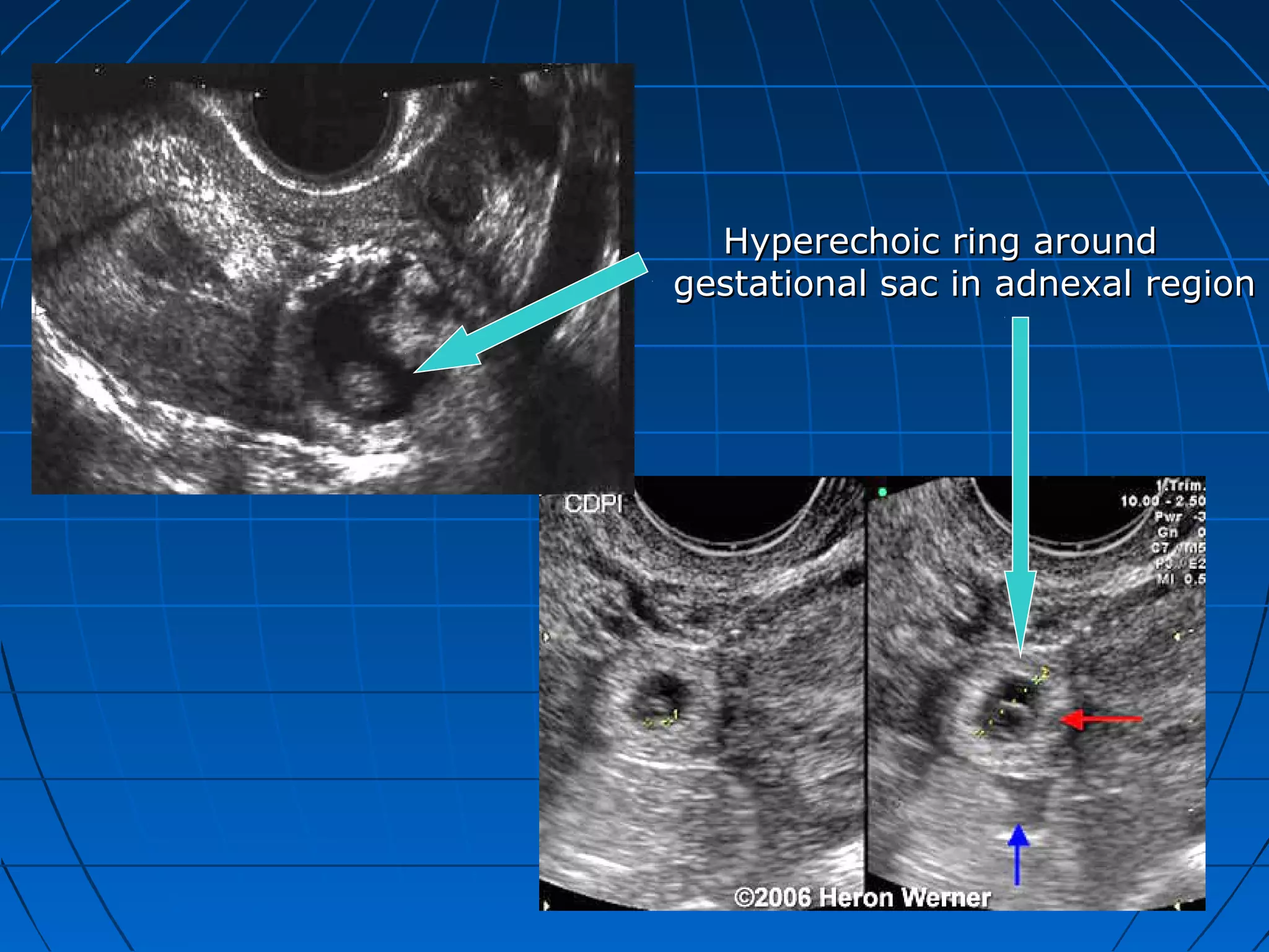 Ectopic pregnancy | PPT