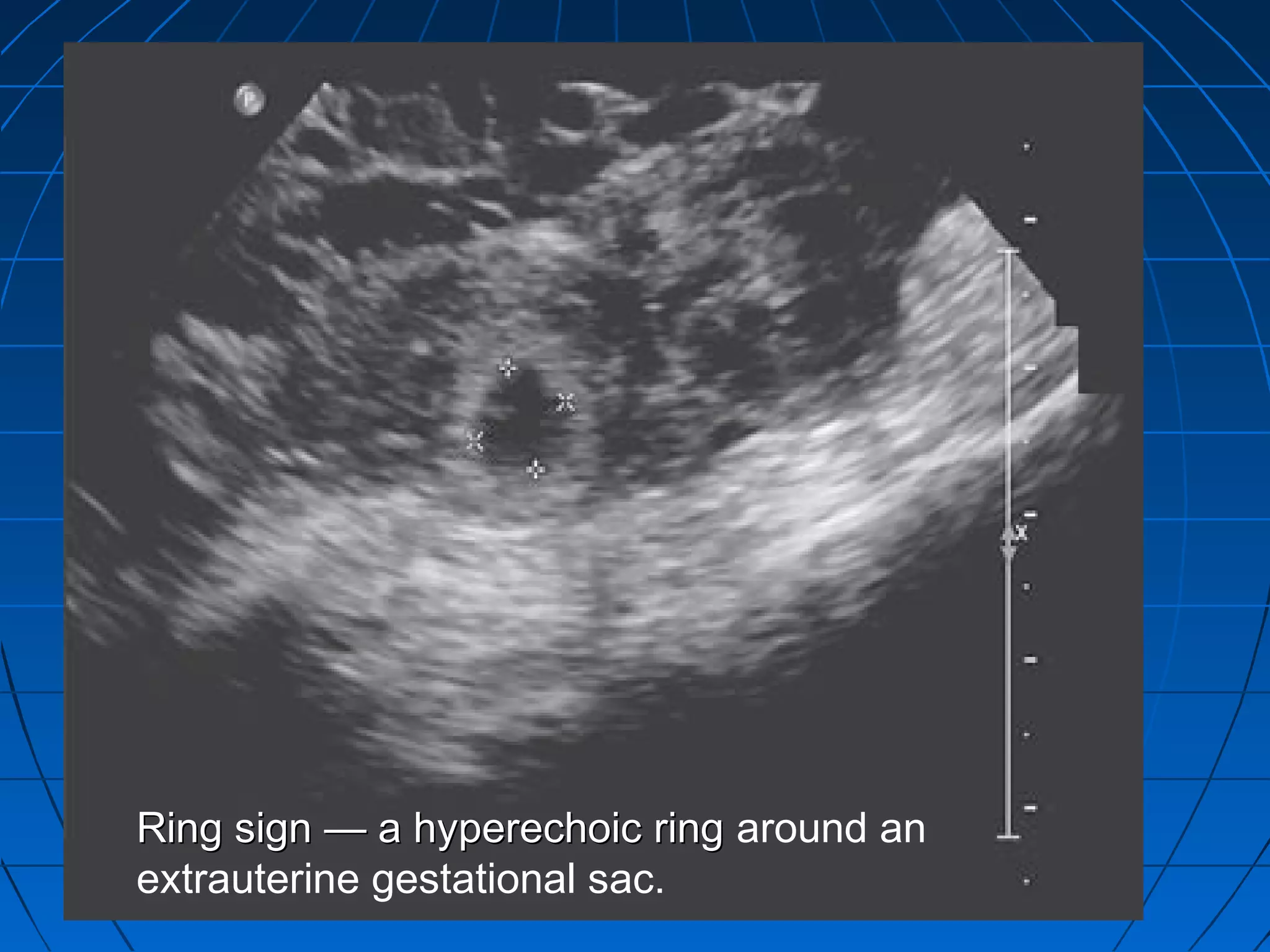 Ectopic pregnancy | PPT