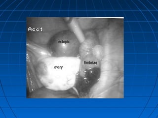 Ectopic pregnancy | PPT