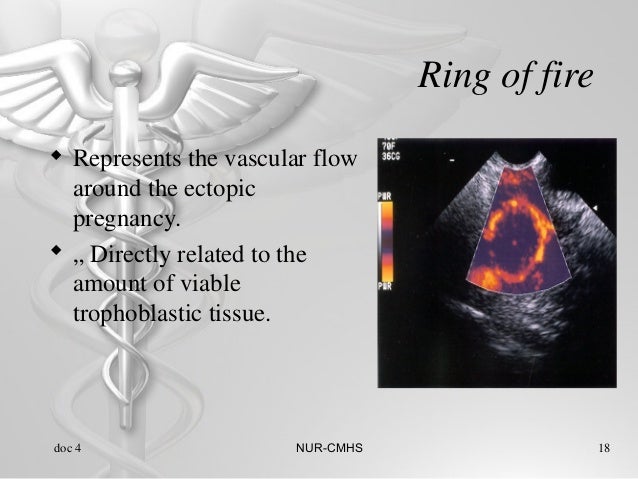 Ectopic pregnancy.presentation pascal m
