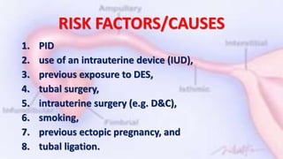Ectopic pregnancy | PPTX