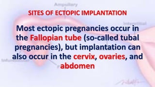 Ectopic pregnancy | PPTX