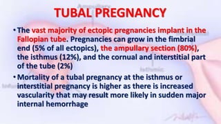 Ectopic pregnancy | PPTX