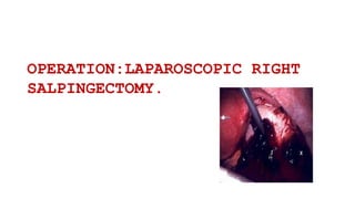 Ectopic pregnancy | PPTX