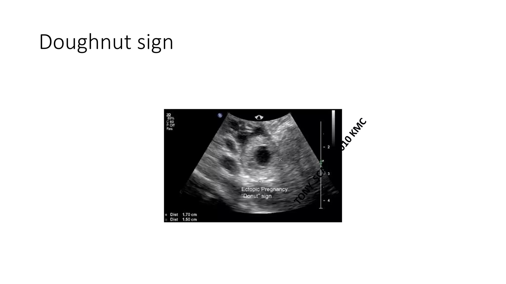 Ectopic pregnancy revision notes | PPT