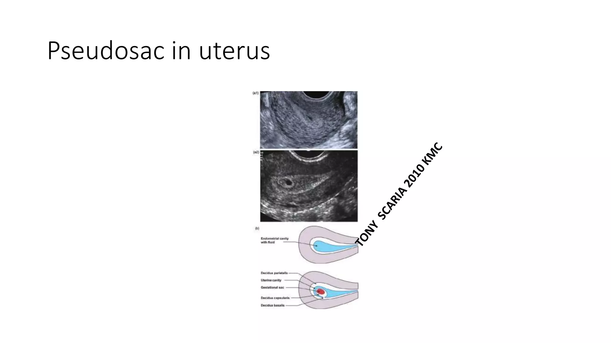 Ectopic Pregnancy Revision Notes Ppt Free Download