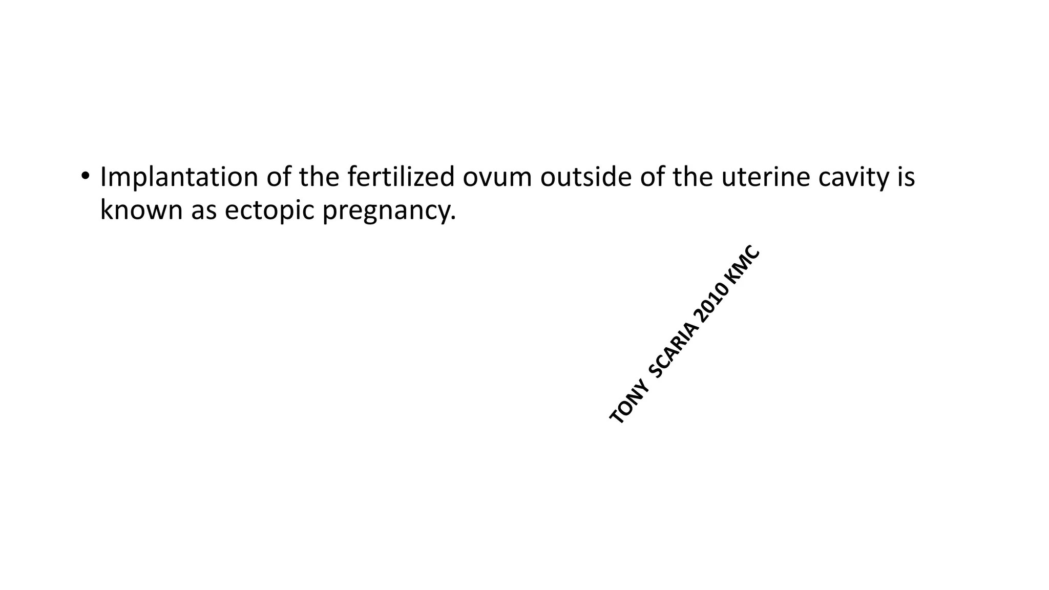 Ectopic pregnancy revision notes | PPT