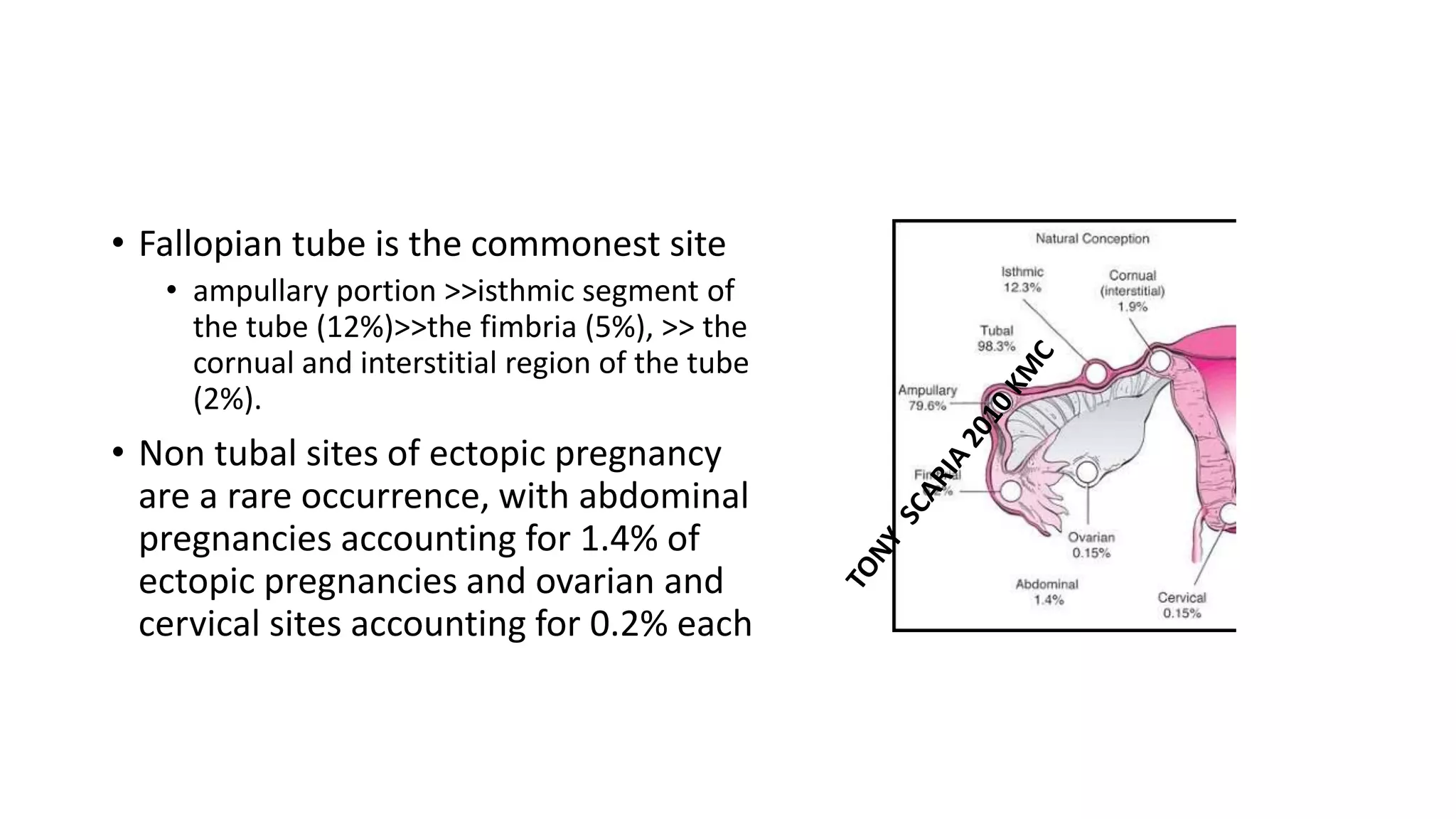 Ectopic pregnancy revision notes | PPT