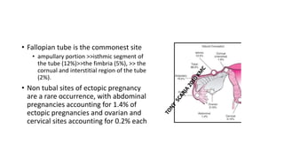 Ectopic pregnancy revision notes | PPT