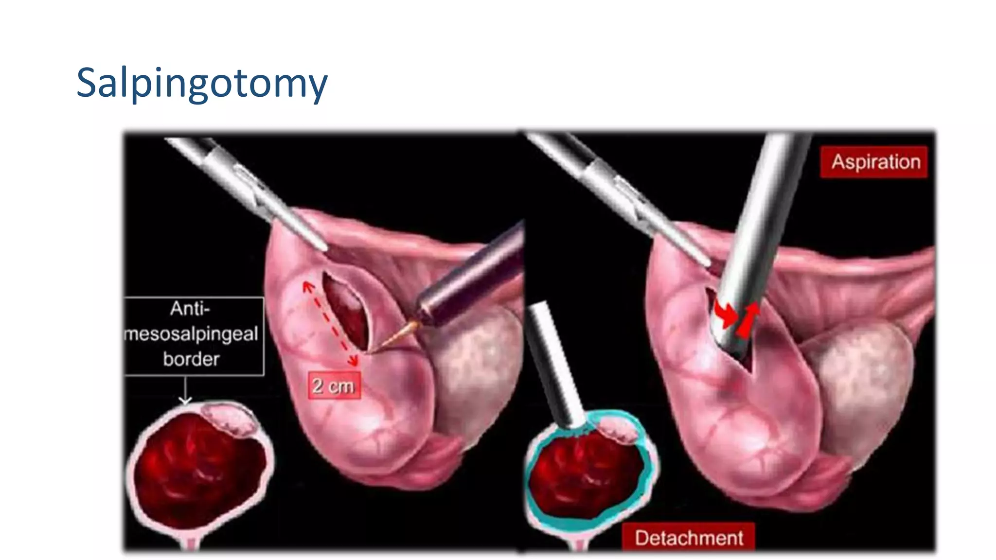 Ectopic pregnancy | PPTX