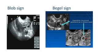 Ectopic pregnancy | PPTX