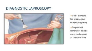 Ectopic pregnancy | PPTX