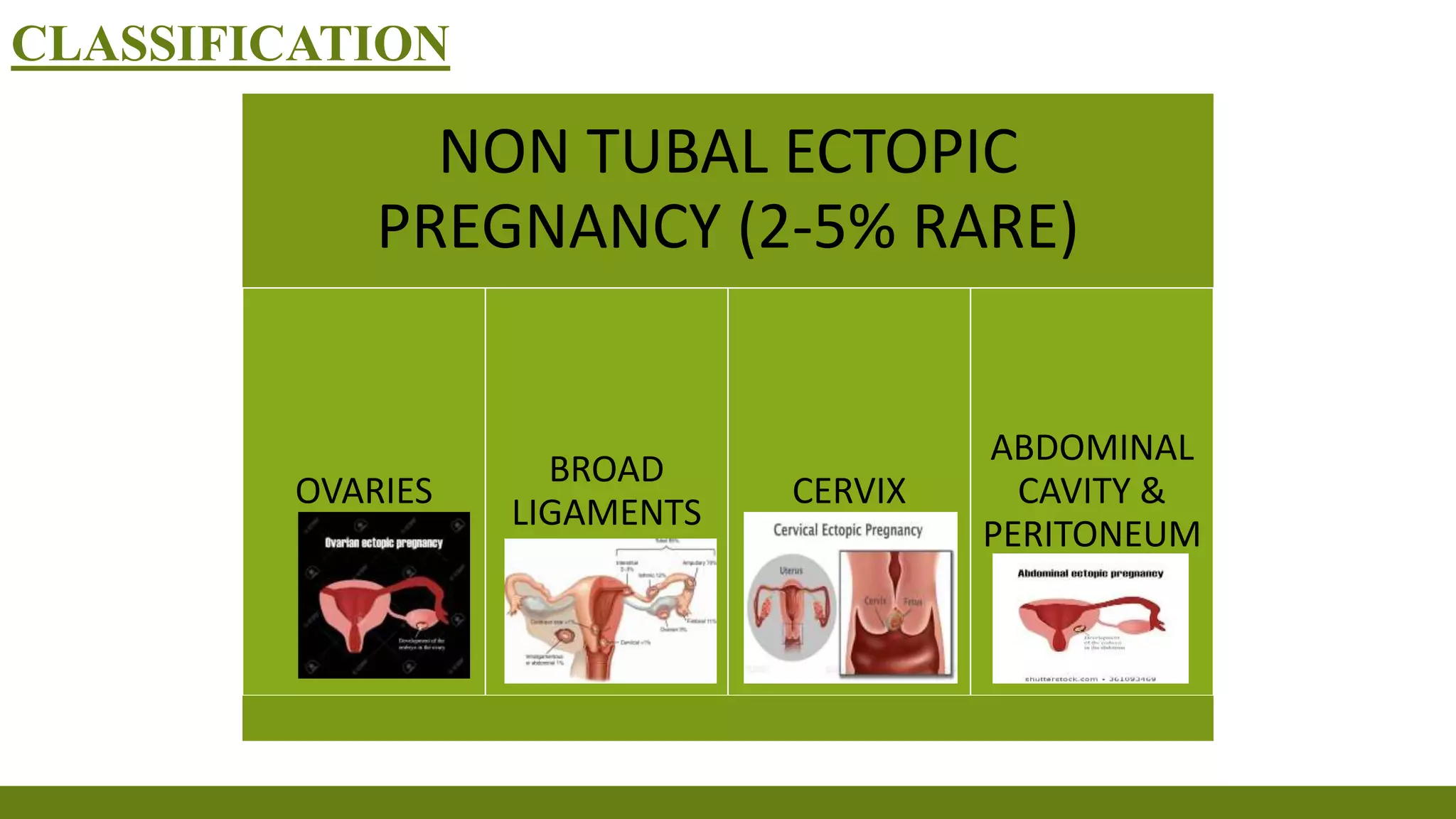 Ectopic pregnancy | PPTX