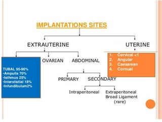Ectopic pregnancy | PPTX