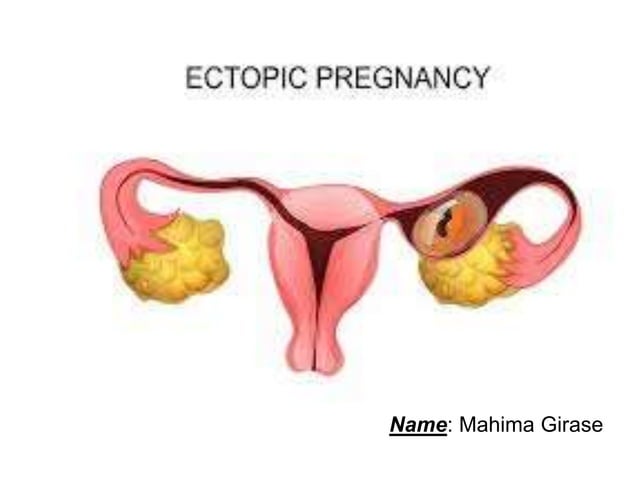 Ectopic pregnancy | PPTX | Pregnancy | Reproductive Health