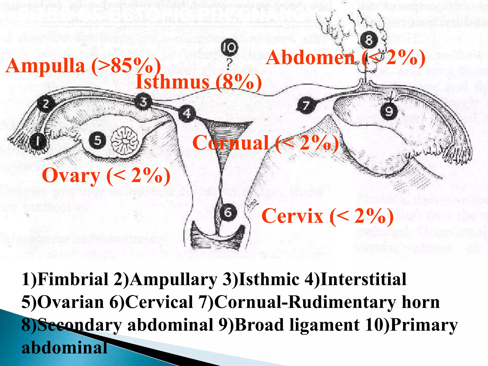 Ectopic pregnancy | PPTX