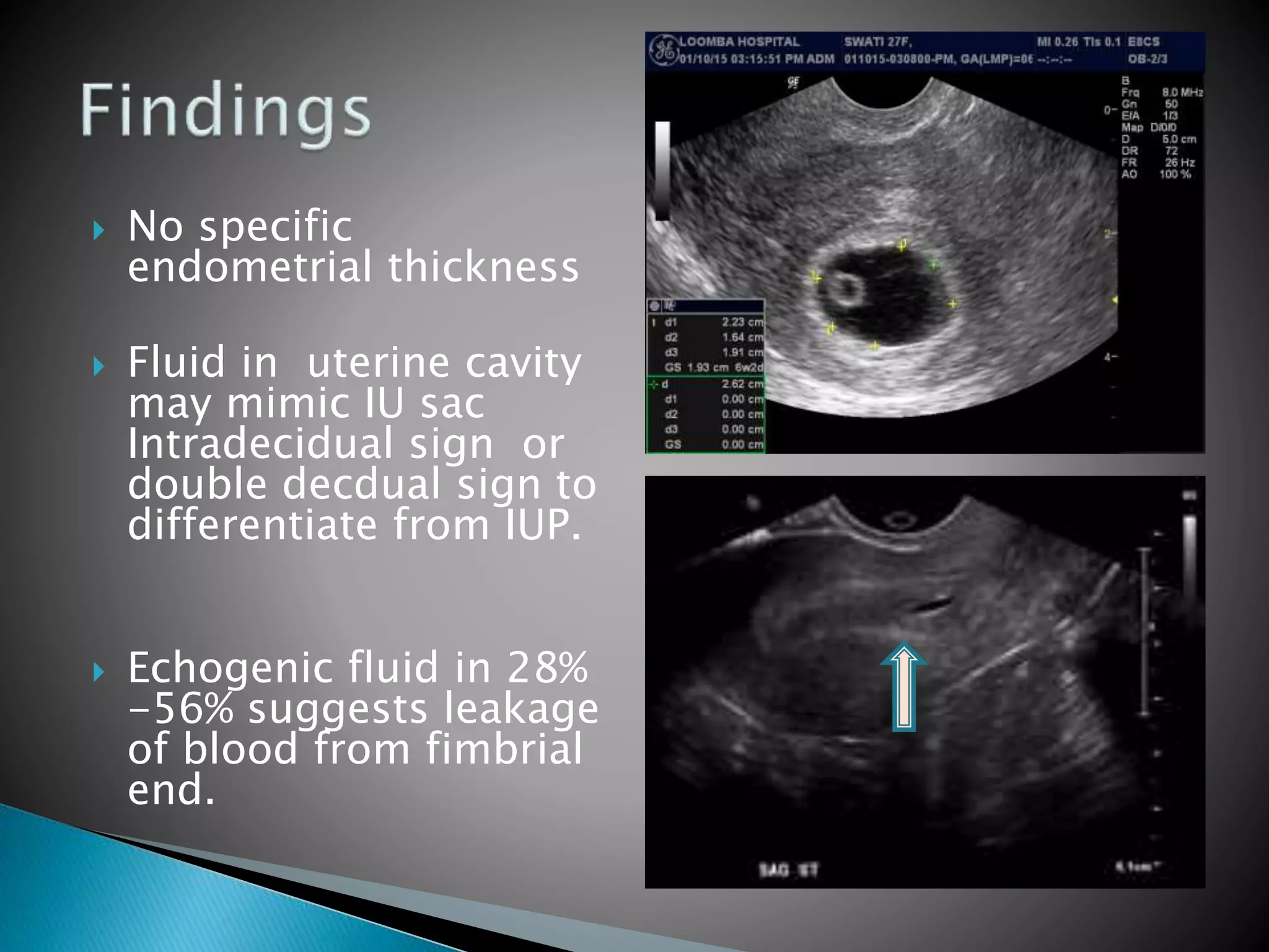 Ectopic pregnancy | PPTX