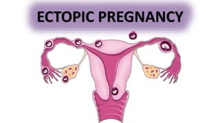ectopic pregnancy.pptx