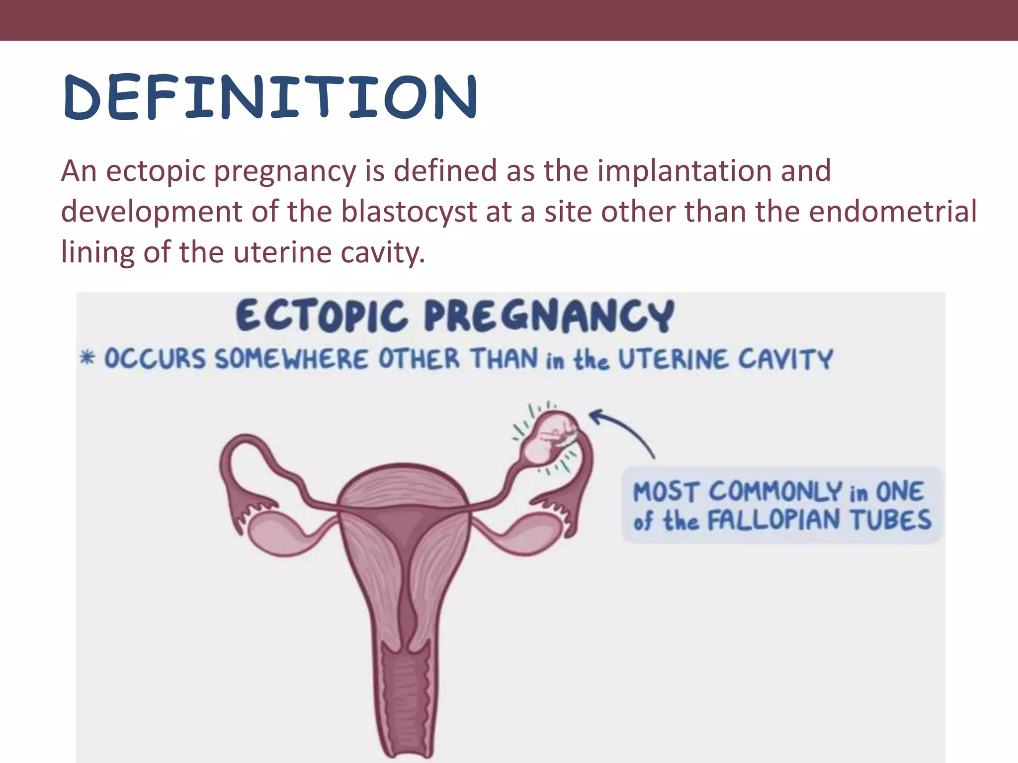ECTOPIC PREGNANCY | PPTX
