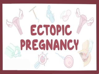 ECTOPIC PREGNANCY | PPTX